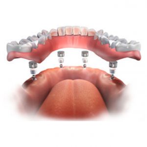 Denture Alternative – NU Teeth | Warm Family Dentistry at Salt Lake ...